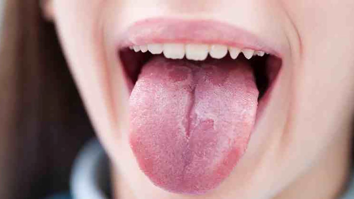 Problemas más frecuentes de la lengua