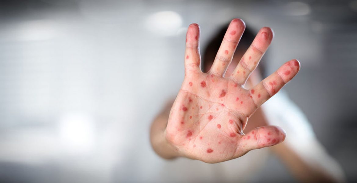 Qué es “mano-boca-pie”, un virus típico en chicos